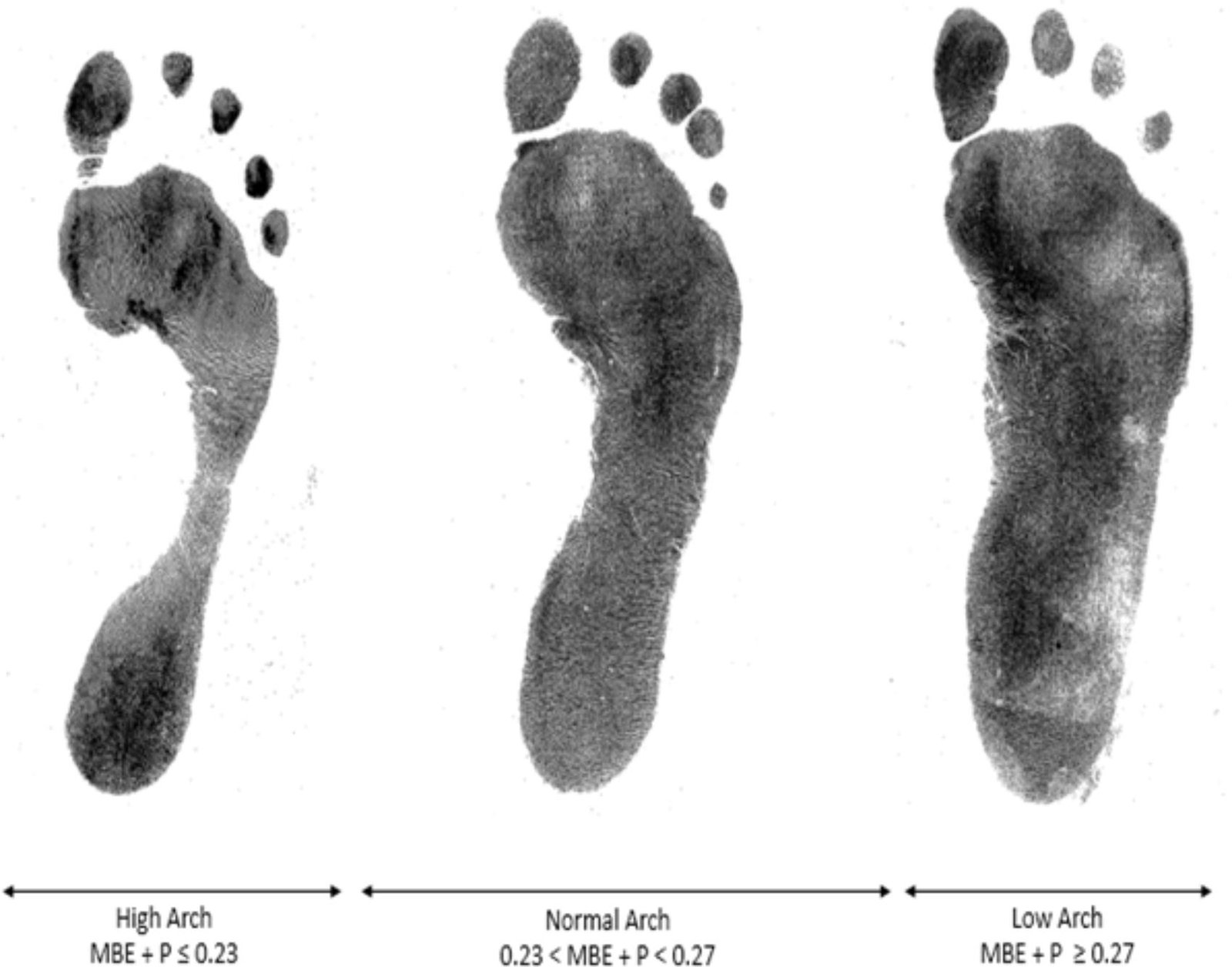 Flat, Normal, or High Arch – Know Your Foot Type Like a Pro - footinst.com